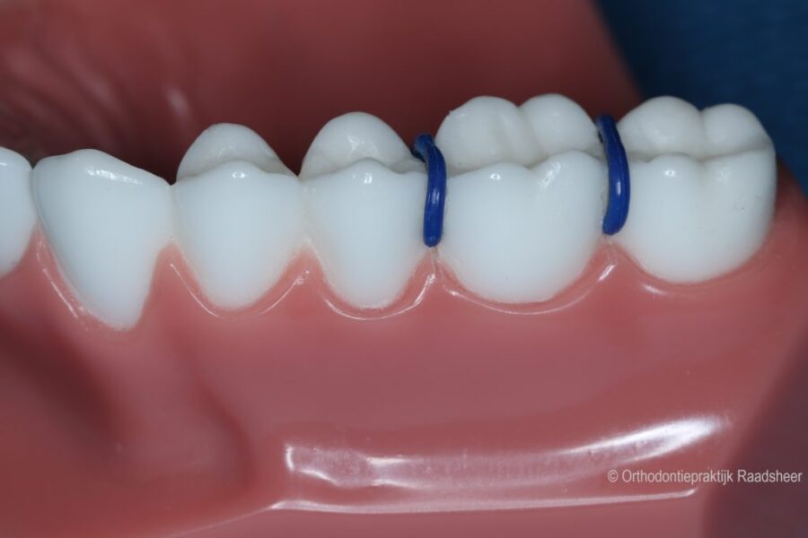 Informatie over separeren - Ortho Maarssen